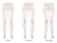 Angular deformities of the lower extremities - Knowledge @ AMBOSS