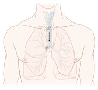 Foreign body aspiration - Knowledge @ AMBOSS