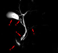 Acute cholangitis - Knowledge @ AMBOSS