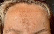 Hyperpigmentation disorders - Knowledge @ AMBOSS