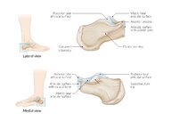 Calcaneal fracture - Knowledge @ AMBOSS