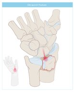 Forearm fractures - Knowledge @ AMBOSS