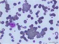 Autoimmune hemolytic anemia - Knowledge @ AMBOSS