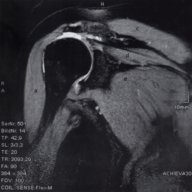Soft tissue lesions of the shoulder - Knowledge @ AMBOSS