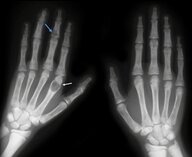 Hyperparathyroidism - Knowledge @ AMBOSS