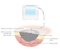 Decubitus ulcers - Knowledge @ AMBOSS