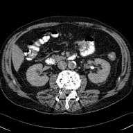 Nephrolithiasis - Knowledge @ AMBOSS