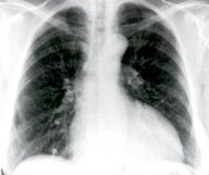 Heart failure - Knowledge @ AMBOSS