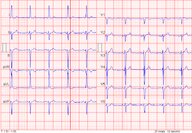 ECG - Knowledge @ AMBOSS