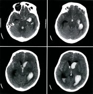 Option 2: Hemorrhagic stroke - Knowledge @ AMBOSS