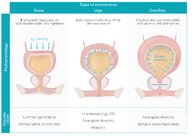 Overactive bladder and urgency urinary incontinence - Knowledge @ AMBOSS