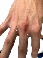 Occupational skin diseases - Knowledge @ AMBOSS