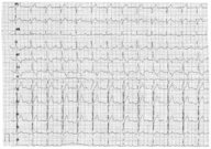 ECG - Knowledge @ AMBOSS