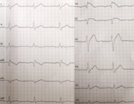 Ventricular tachycardia - Knowledge @ AMBOSS