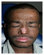 Xeroderma pigmentosum - Knowledge @ AMBOSS