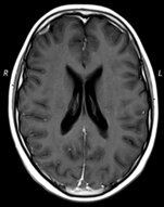 Cerebral venous thrombosis - Knowledge @ AMBOSS