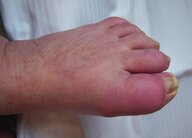 Gout and hyperuricemia - Knowledge @ AMBOSS