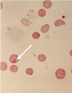 Hemolytic anemia - Knowledge @ AMBOSS