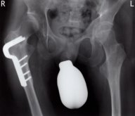 Femoral neck abnormalities - Knowledge @ AMBOSS