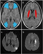 Ischemic stroke - Knowledge @ AMBOSS