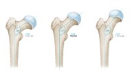Femoral neck abnormalities - Knowledge @ AMBOSS