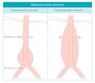 Abdominal aortic aneurysm - Knowledge @ AMBOSS