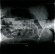 Paralytic ileus - Knowledge @ AMBOSS