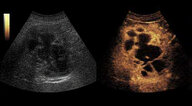 Pyogenic liver abscess - Knowledge @ AMBOSS
