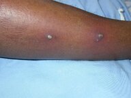 Skin and soft tissue infections - Knowledge @ AMBOSS