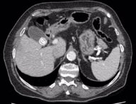 Cholelithiasis - Knowledge @ AMBOSS