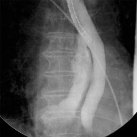 Esophageal perforation - Knowledge @ AMBOSS