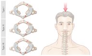 Cervical spine injuries - Knowledge @ AMBOSS