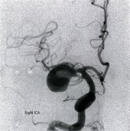 Aneurysm - Knowledge @ AMBOSS