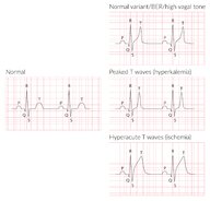 ECG - Knowledge @ AMBOSS