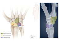 Carpal ligament injuries - Knowledge @ AMBOSS