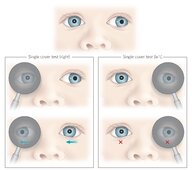Examination of the eye - Knowledge @ AMBOSS