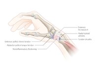 Noninfectious tenosynovitis - Knowledge @ AMBOSS