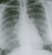 Acute rheumatic fever - Knowledge @ AMBOSS