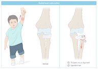 Radial head subluxation - Knowledge @ AMBOSS