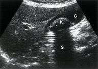 Cholelithiasis - Knowledge @ AMBOSS