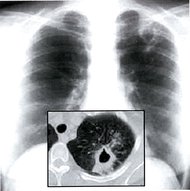 Tuberculosis - Knowledge @ AMBOSS