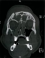 Facial fractures - Knowledge @ AMBOSS