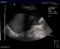 Paracentesis - Knowledge @ AMBOSS