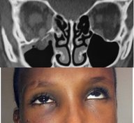 Traumatic eye injuries - Knowledge @ AMBOSS