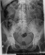 Gastrointestinal perforation - Knowledge @ AMBOSS
