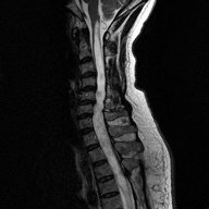 Syringomyelia - Knowledge @ AMBOSS