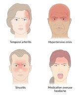 Medication overuse headache - Knowledge @ AMBOSS