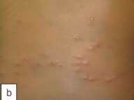 Hypersensitivity reactions - Knowledge @ AMBOSS