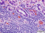 MALT lymphoma - Knowledge @ AMBOSS