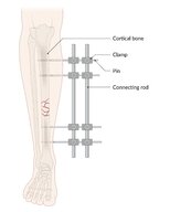 Tibial and fibular fractures - Knowledge @ AMBOSS